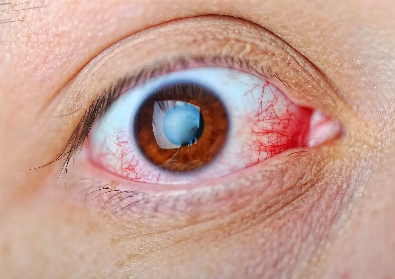Eye Injuries: Types, Causes, and Treatment Methods